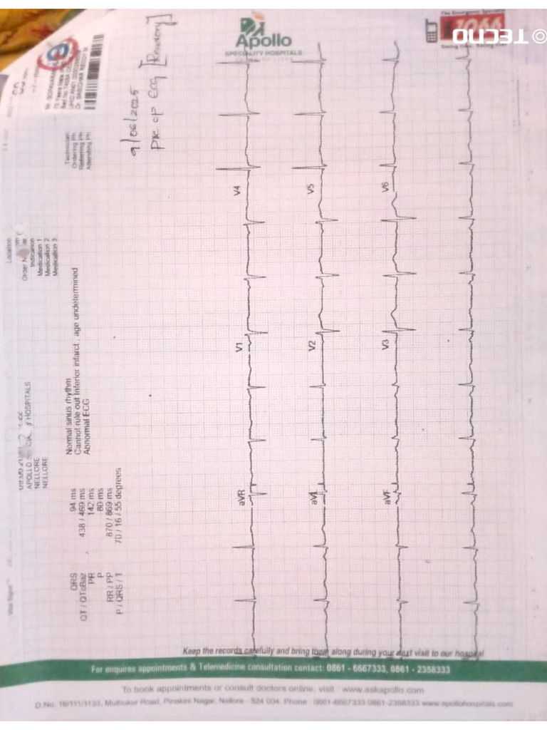 Ecg 2 | PDF