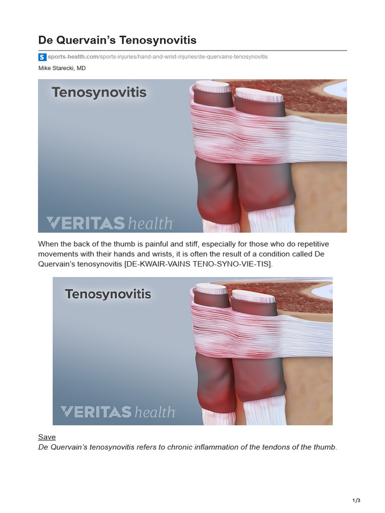 Sports Health - Com de Quervains Tenosynovitis | PDF | Thumb | Clinical ...
