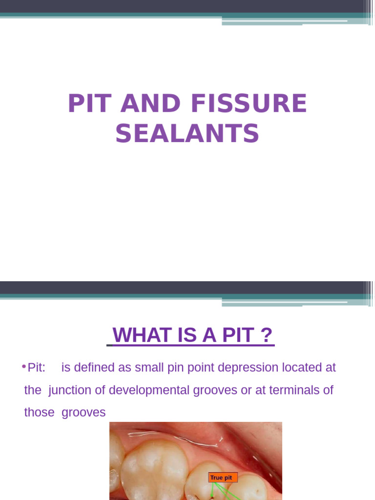 Pit and Fissure Sealants Overview | PDF | Tooth Enamel | Dentistry
