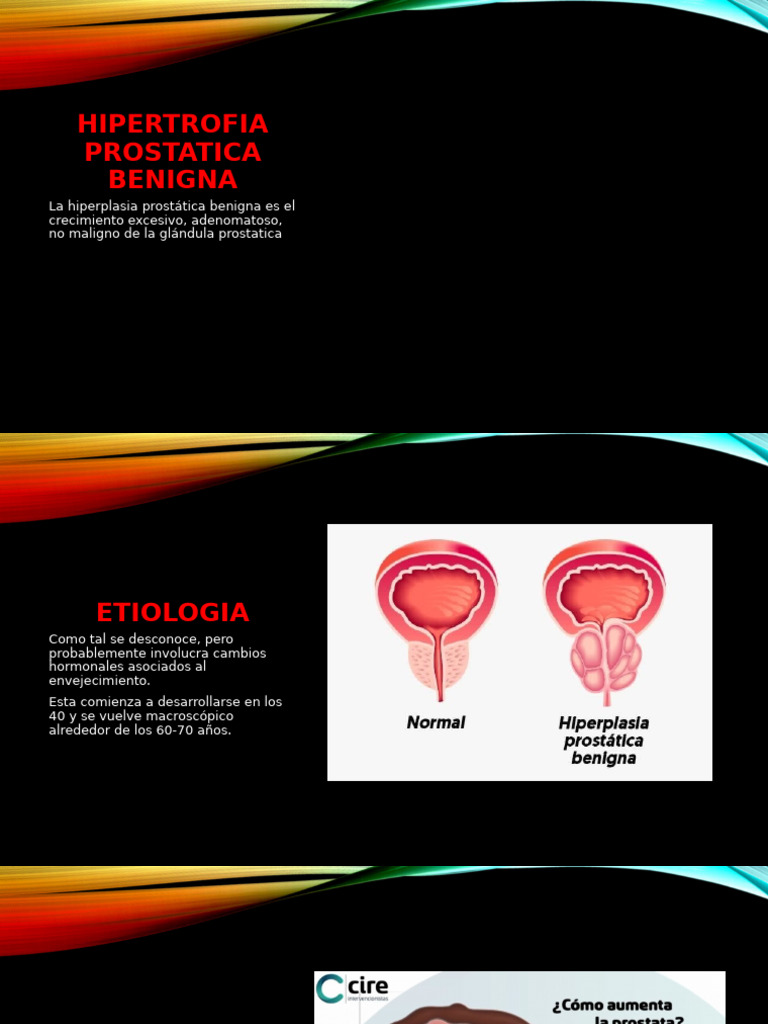 Hipertrofia Prostatica Benigna | PDF
