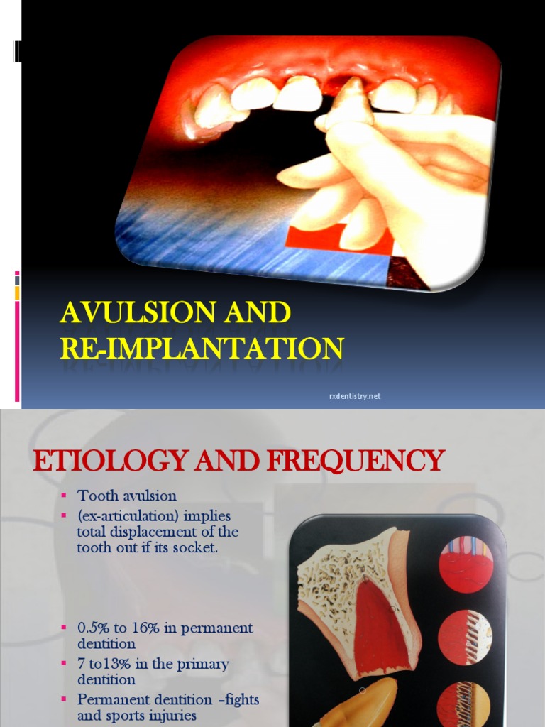 Avulsion and Replantation | Human Tooth | Healing