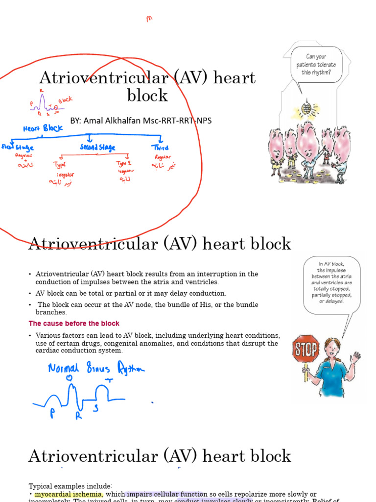 Understanding AV Heart Blocks | PDF | Heart | Electrophysiology