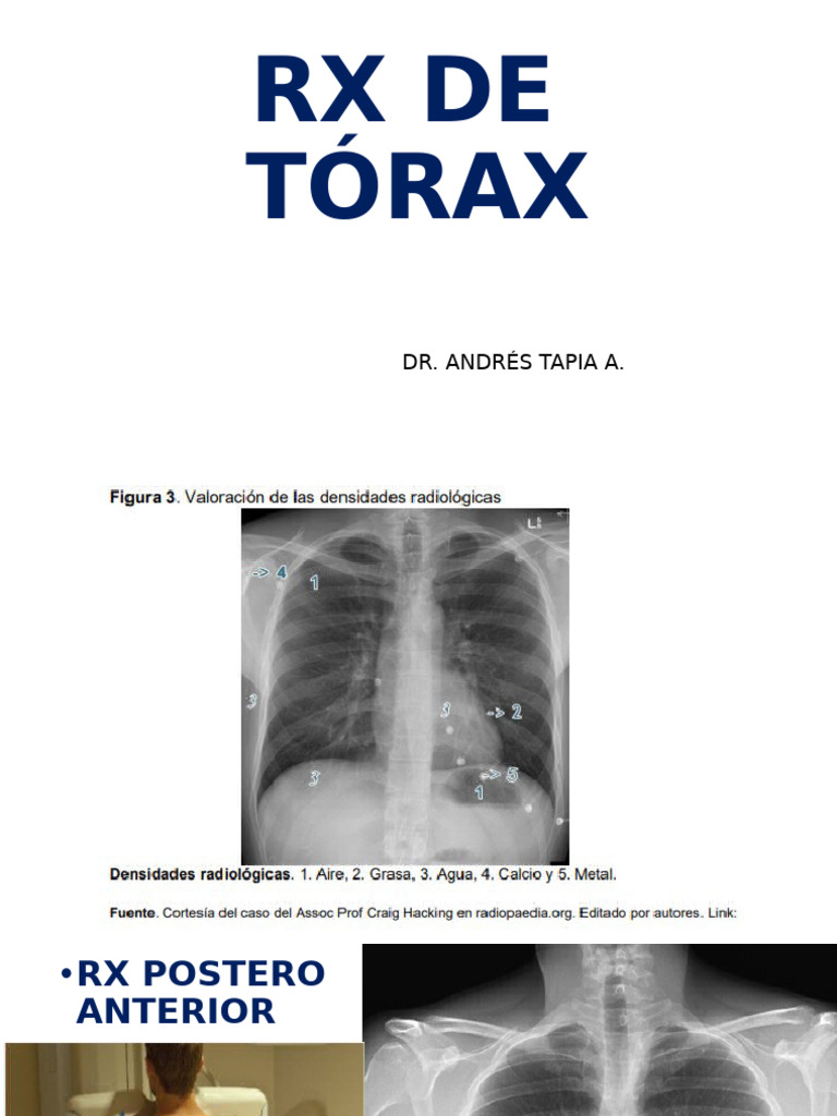 RX de Tórax | PDF