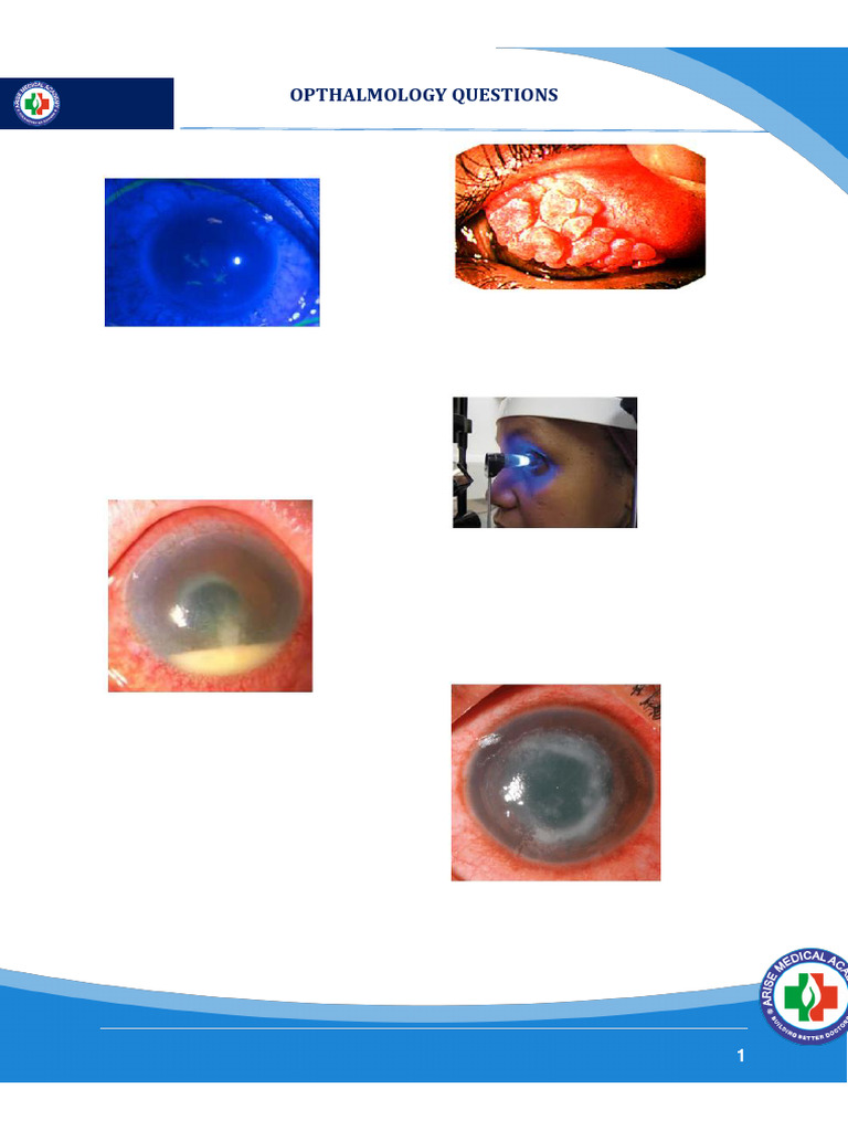 Ophthalmology Test and Discussion Questions | PDF | Cataract | Glaucoma