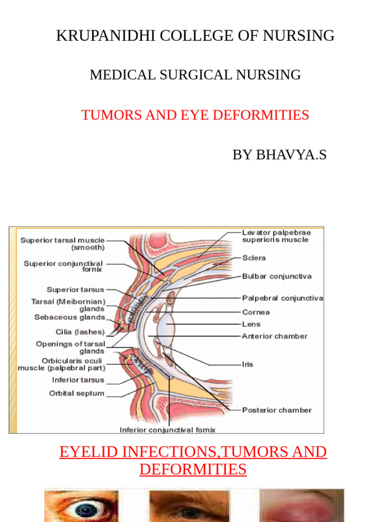Eyelid Infections, Tumors and Deformities - 3rd BSC | PDF