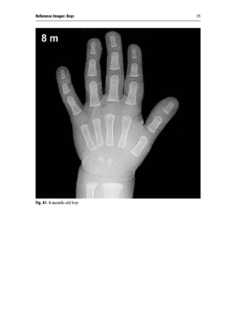 Atlas Hand Bone Age | PDF
