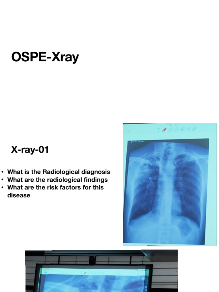 Ospe Chest | PDF