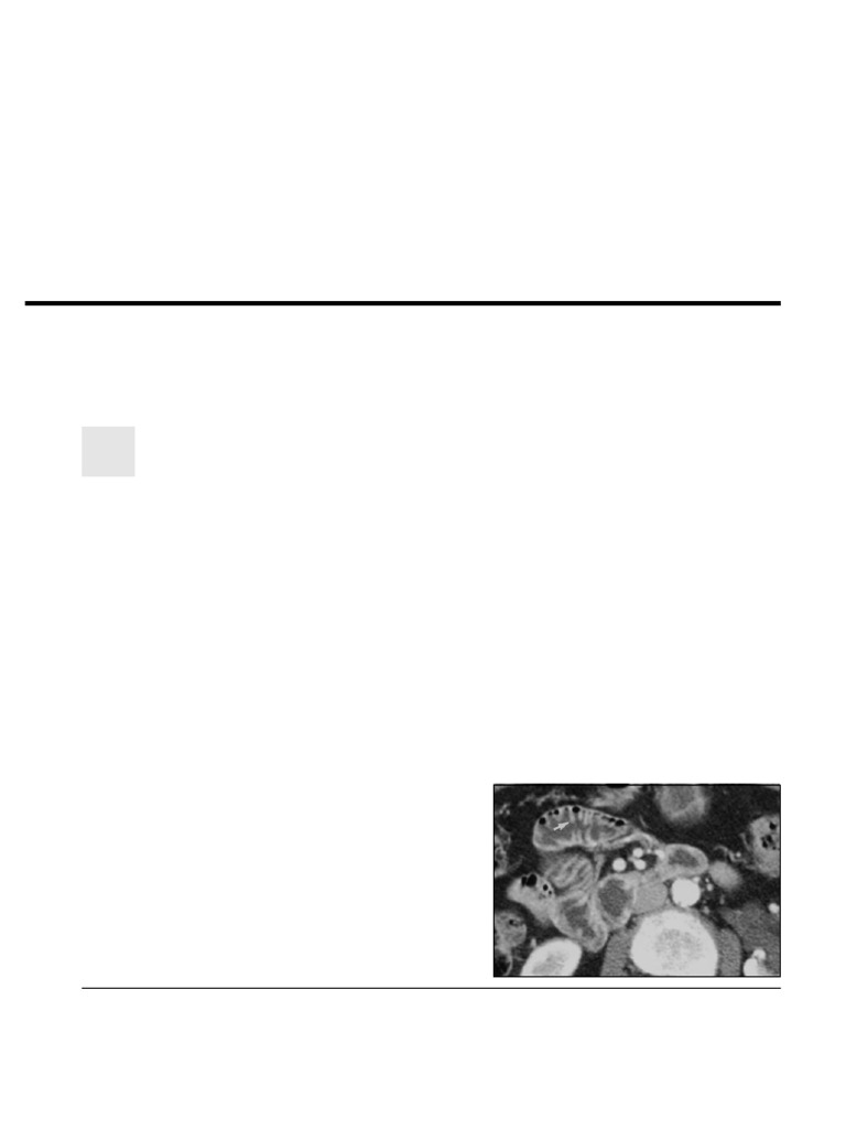 CT of Bowel Wall | PDF | Gastrointestinal Tract | Ct Scan