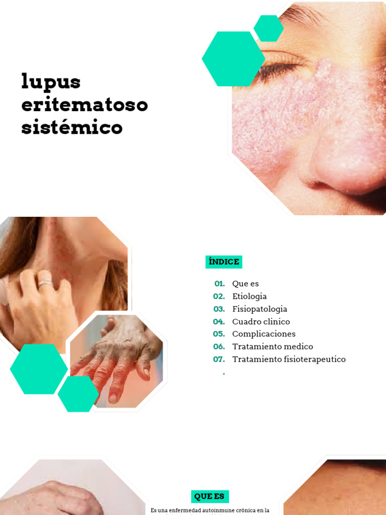 Lupus | PDF | Especialidades Medicas | Enfermedades y trastornos