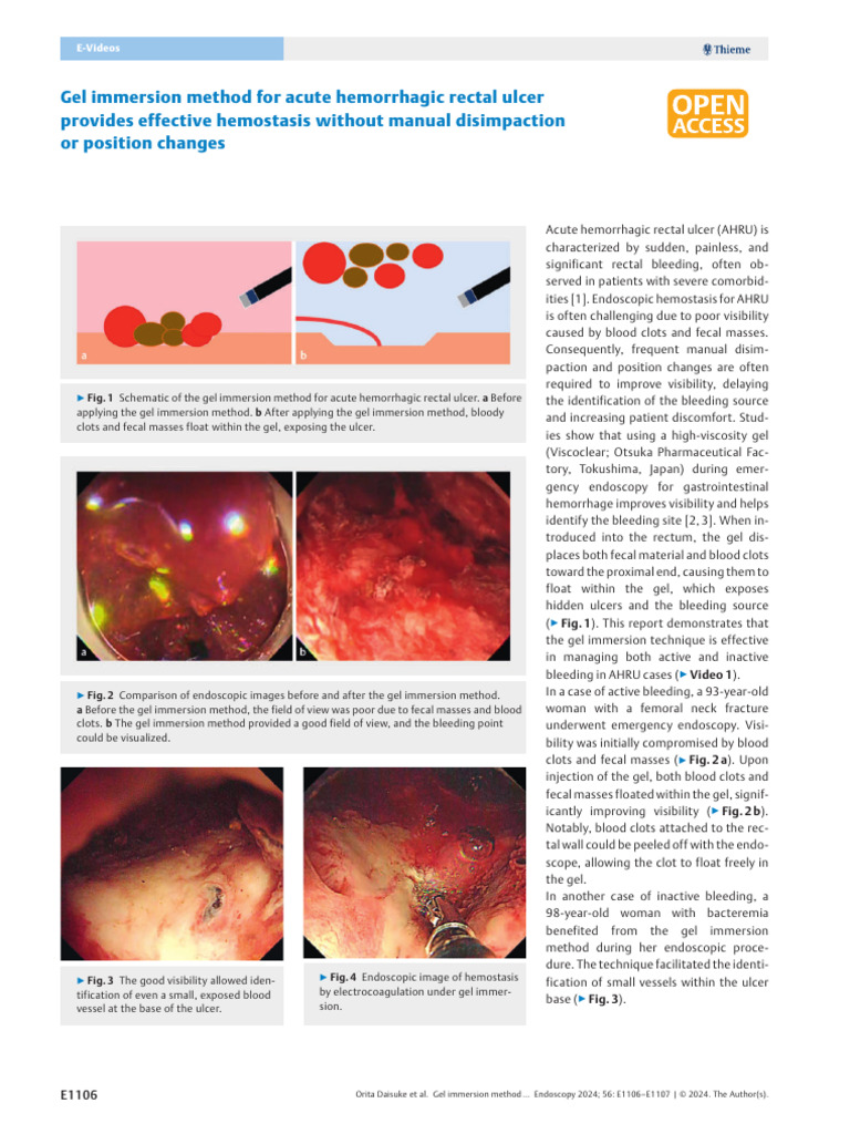 Gel Immersion Method For Acute Hemorrhagic Rectal Ulcer Provides | PDF ...