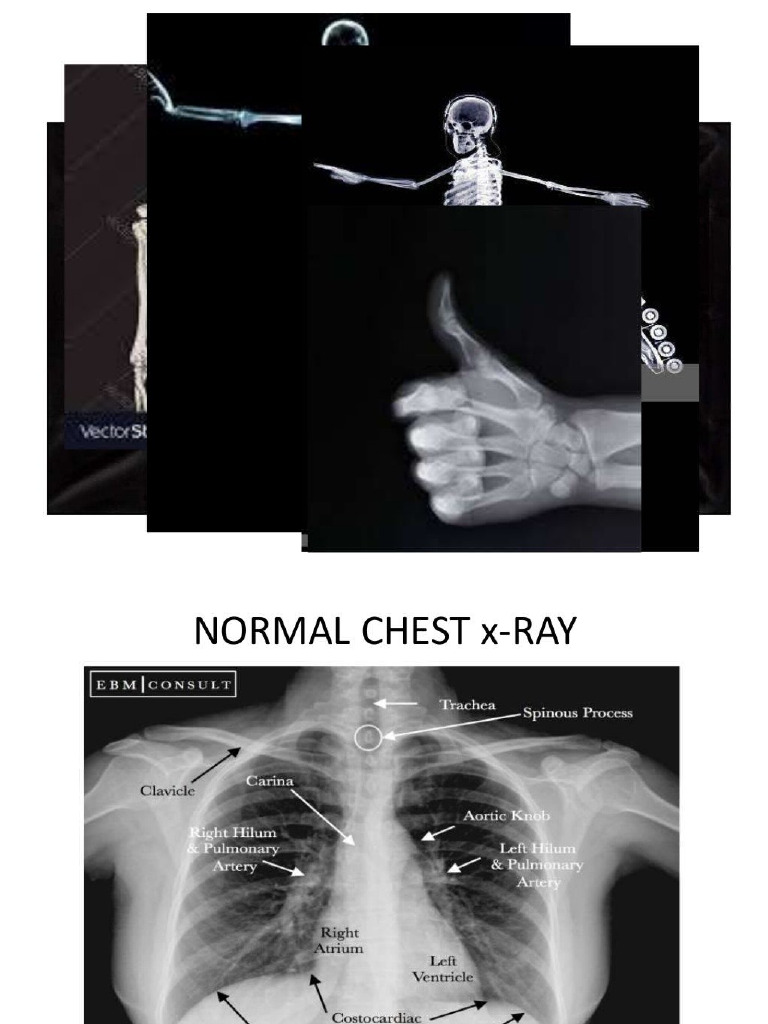 Chest X-Ray | PDF