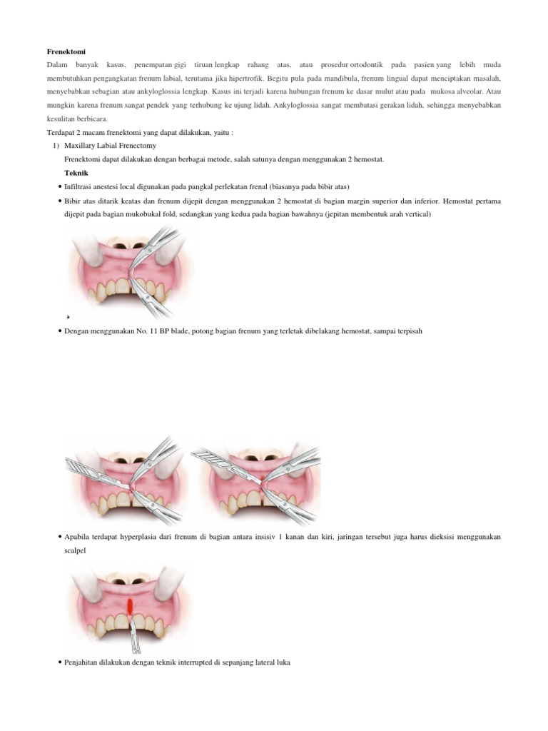 Frenektomi | PDF