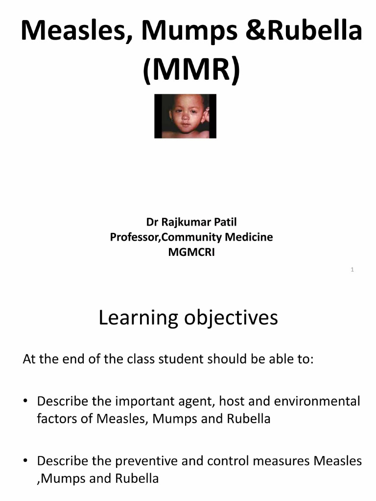 Mumps | PDF
