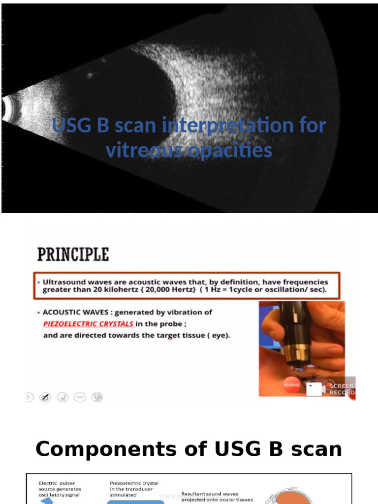 USG B Scan for Vitreous Opacities | PDF