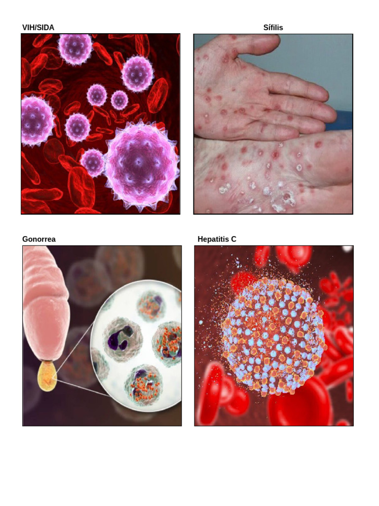 10 Enfermedades de Transmisión Sexual (ETS) VIH | PDF