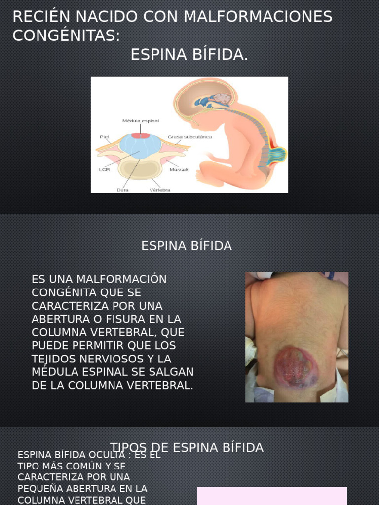 Espina Bífida | PDF