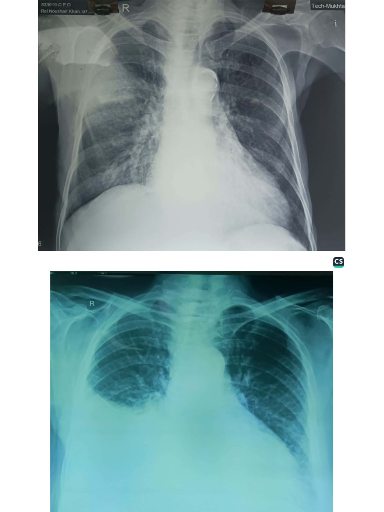 Chest Xrays | PDF
