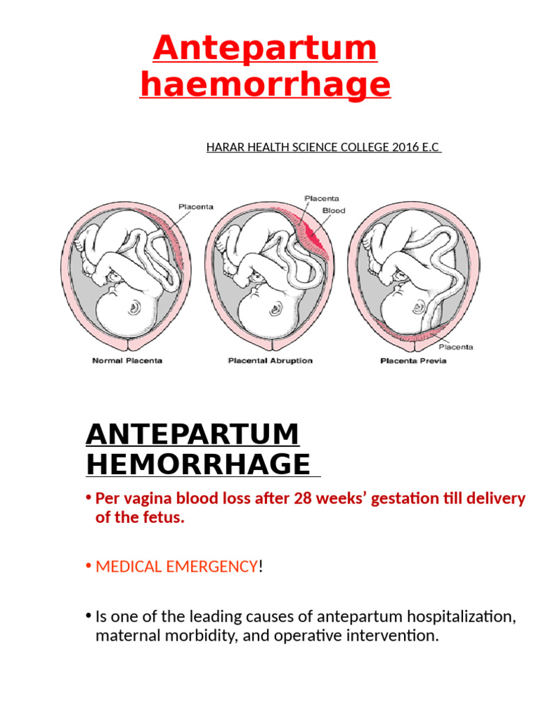 Understanding Antepartum Hemorrhage | PDF | Childbirth | Human Reproduction