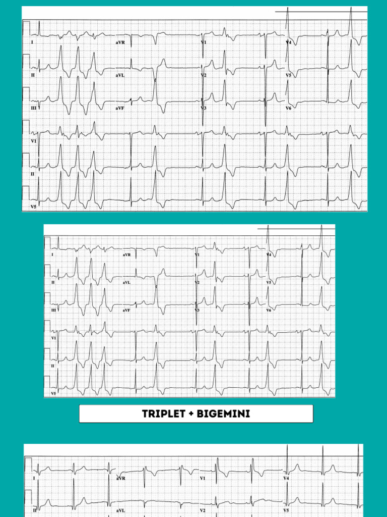 ECG Quiz (Jawaban) | PDF