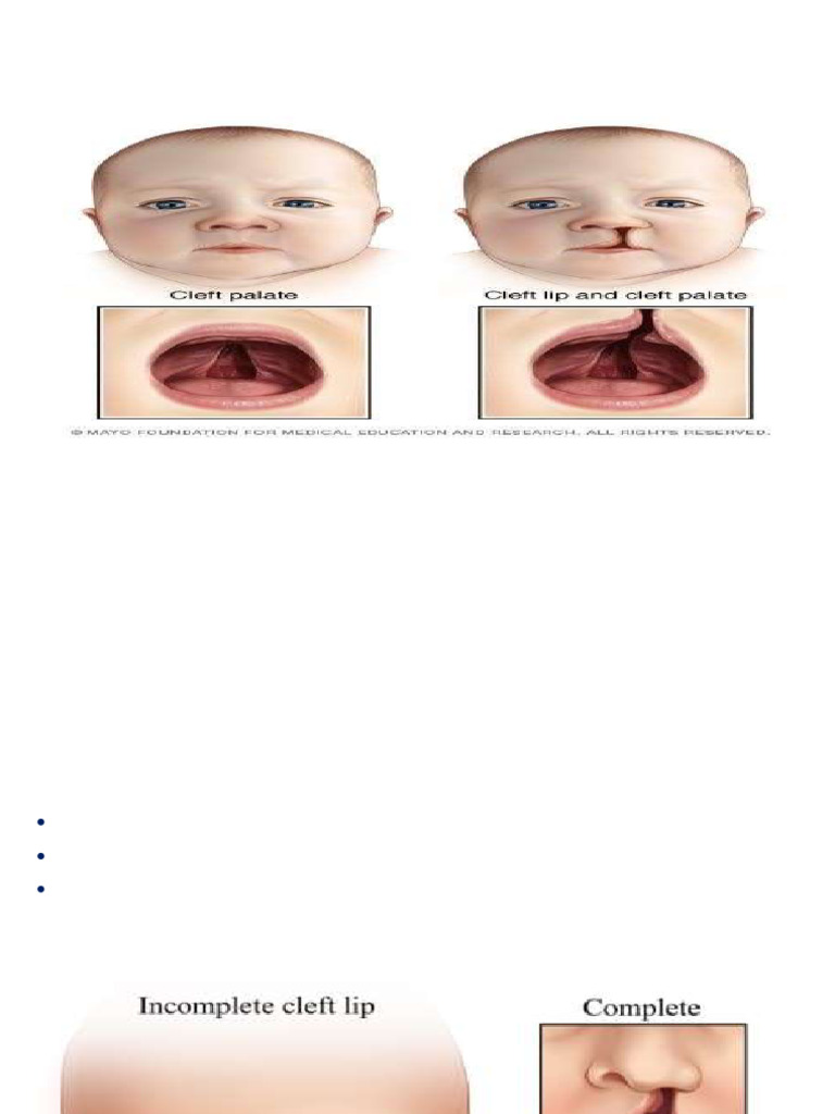 Cleft Lip and Palate Overview | PDF | Face | Facial Features
