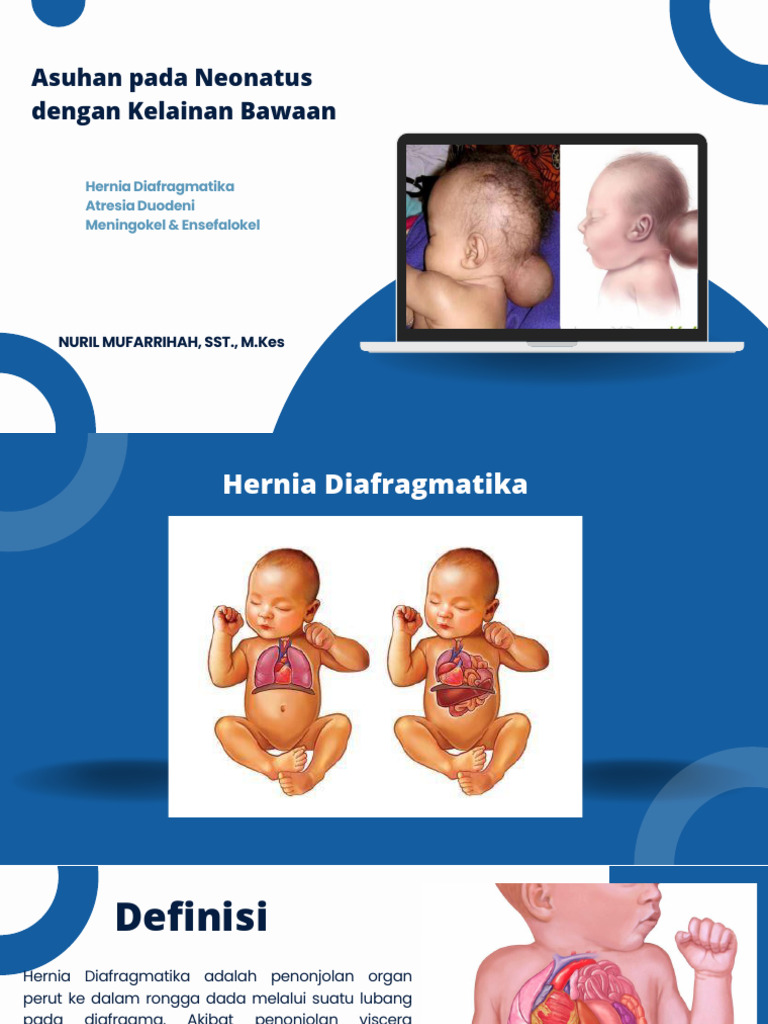Asuhan Neonatus: Hernia & Atresia Duodenum | PDF