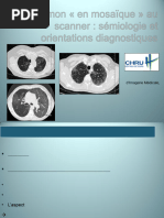 Syndrome bronchique et épaississement pariétal | PDF