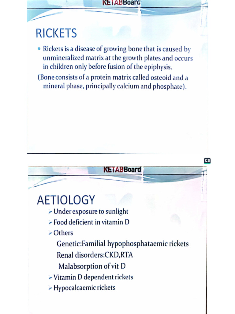 Rickets (Pediatrics) | PDF