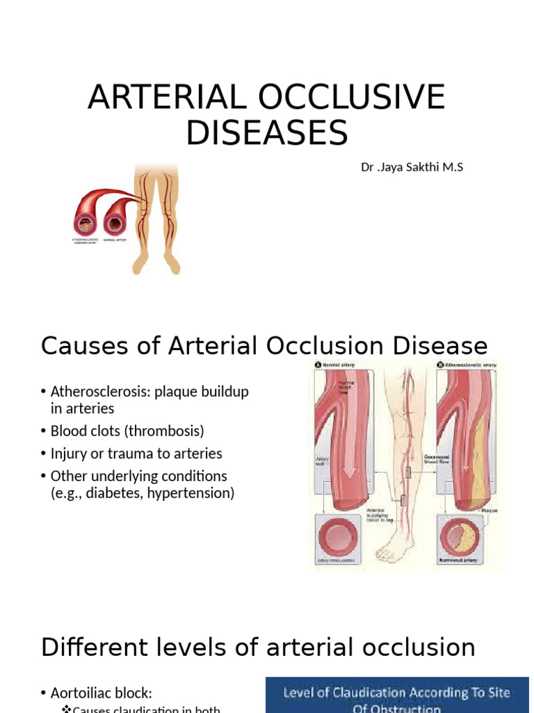 Arterial Occlusive Diseases | PDF