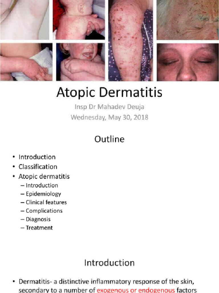 Atopic Dermatitis | PDF