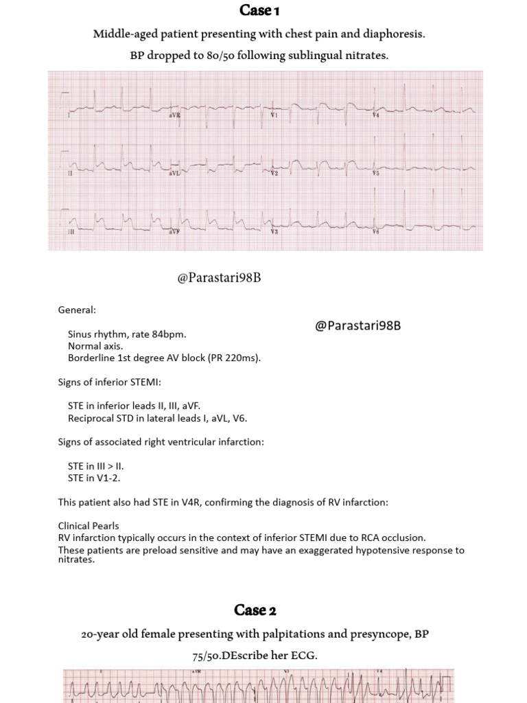 ECG Interpretations in Critical Cases | PDF | Electrocardiography ...
