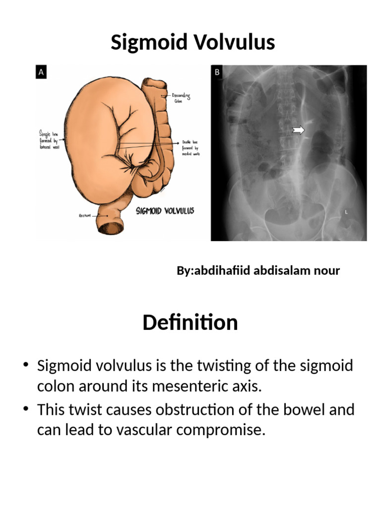 Sigmoid Volvulus: Overview and Management | PDF | Large Intestine ...