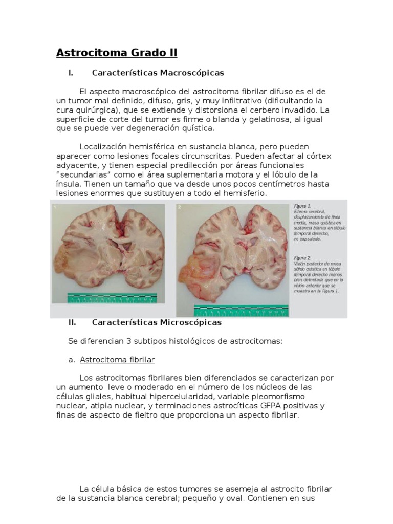 Astrocitoma Grado II: Características y Diagnóstico | PDF | Tumor ...