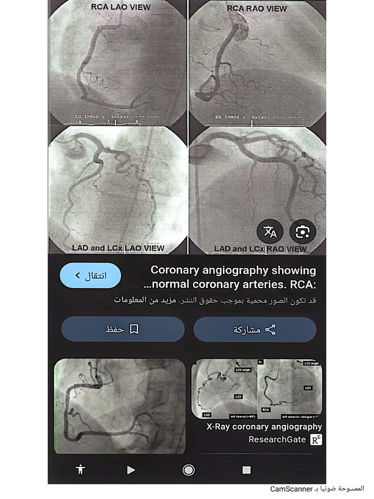 Coronary Angio | PDF