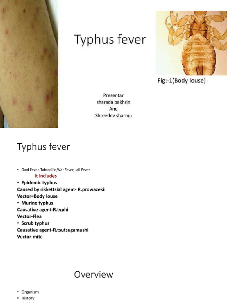 Typhus Fever 2 | PDF