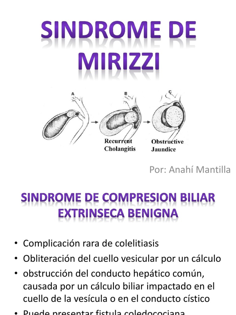 Sindrome de Mirizzi