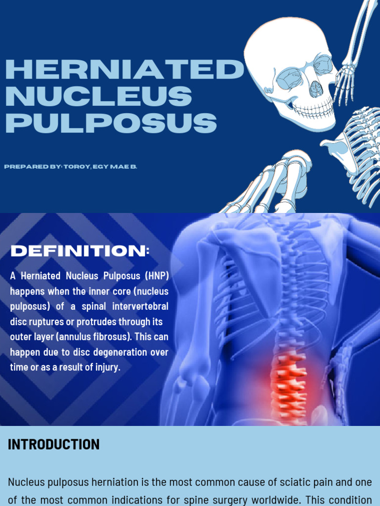 Understanding Herniated Nucleus Pulposus | PDF
