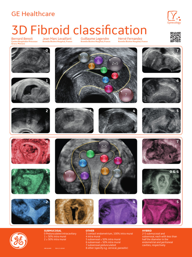 300 13 U019E - JB61828XE - Poster A3 - 3D Fibroid Classification | PDF