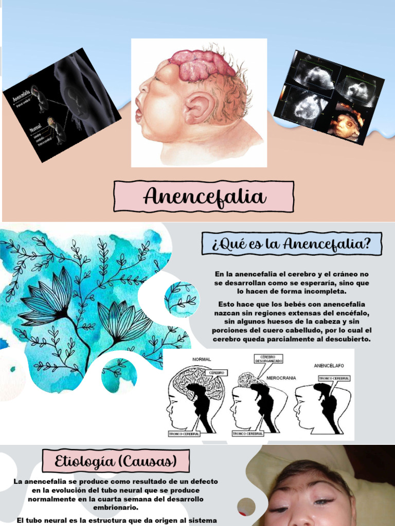 Anencefalia y Microcefalia: Causas y Pronóstico | PDF | El embarazo ...