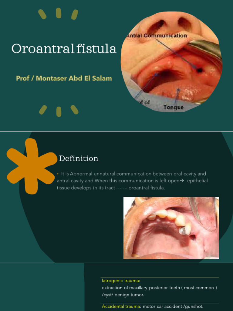 Oroantral Fistula | PDF