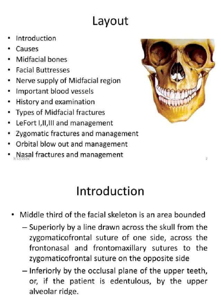 Midface Fracture OMFS | PDF