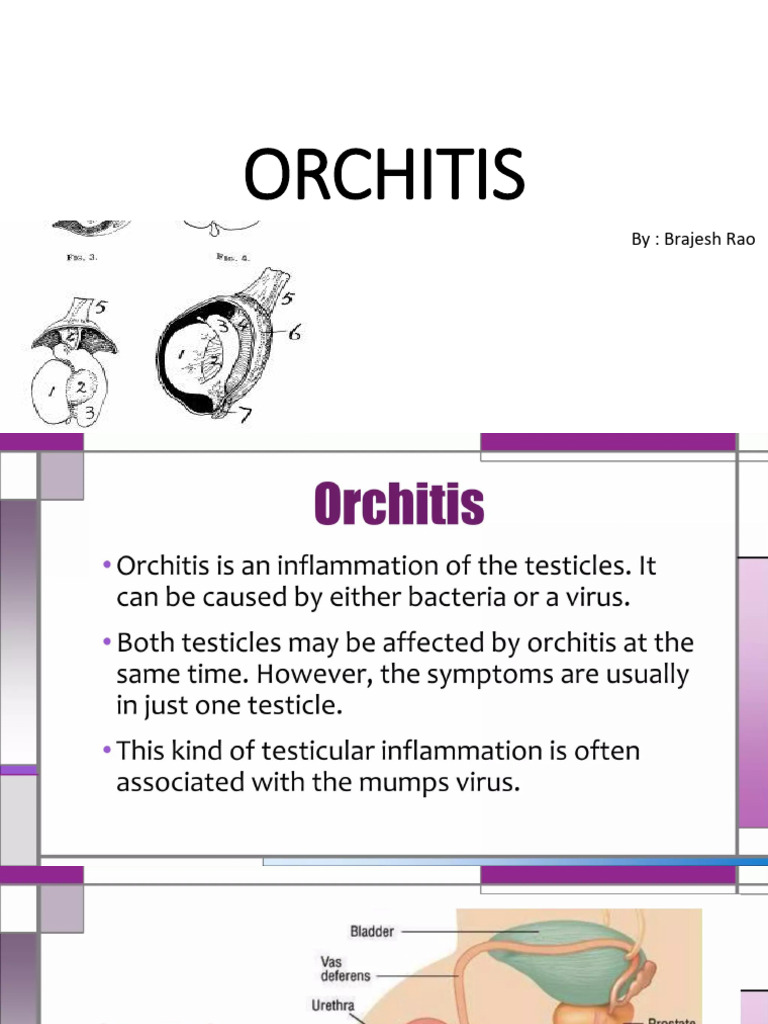 Orchitis | PDF