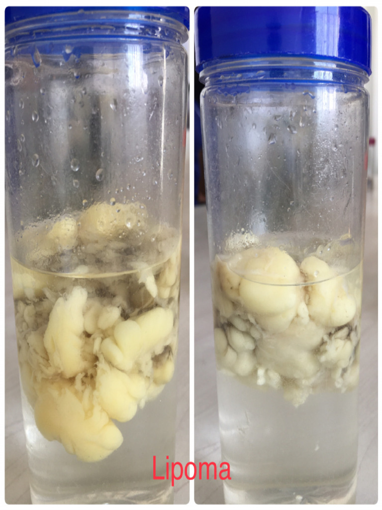 Surgery Specimen | PDF