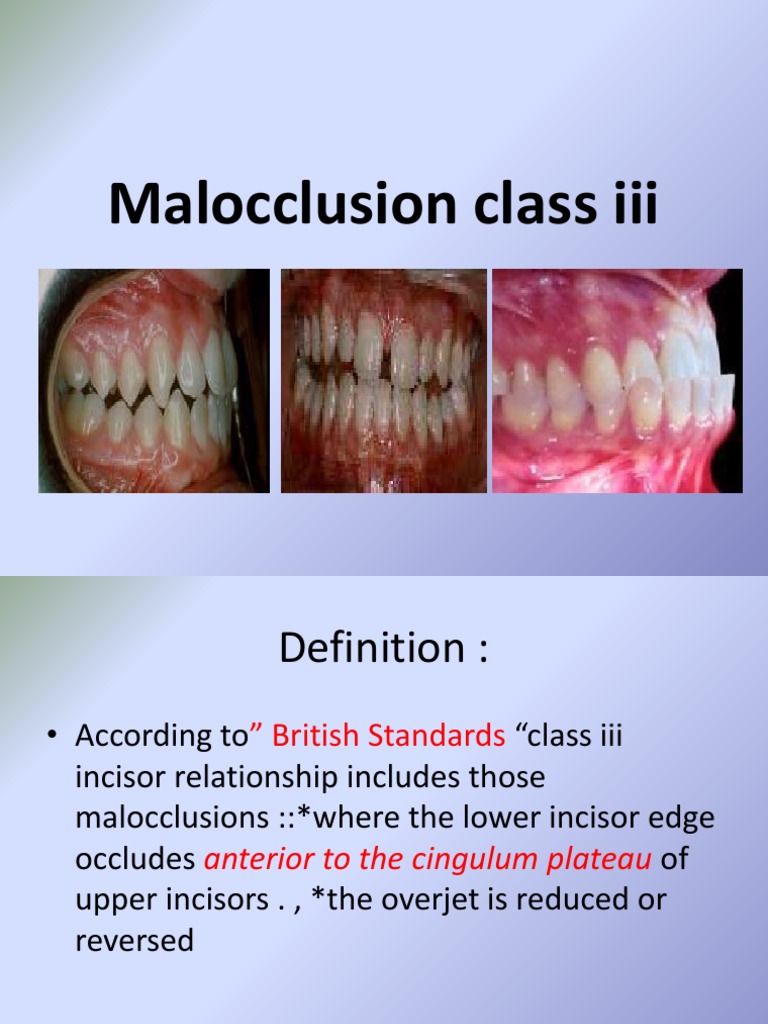 Malocclusion Class III | PDF | Dental Anatomy | Dentistry Branches