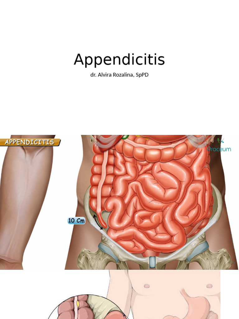 Appendicitis | PDF