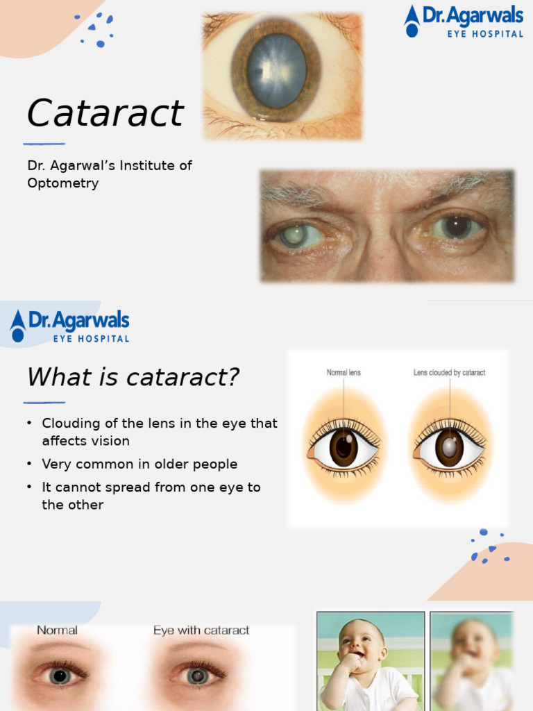 Cataract | PDF