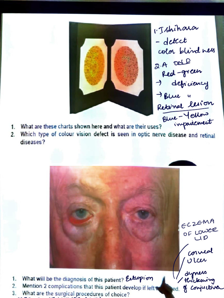 Optha Practical | PDF | Glaucoma | Medical Specialties