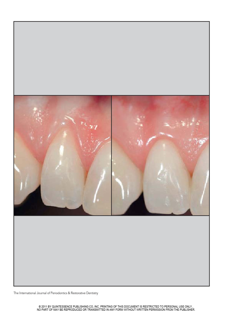 Esthetic Evaluation of Root Coverage | PDF | Mouth | Clinical Medicine