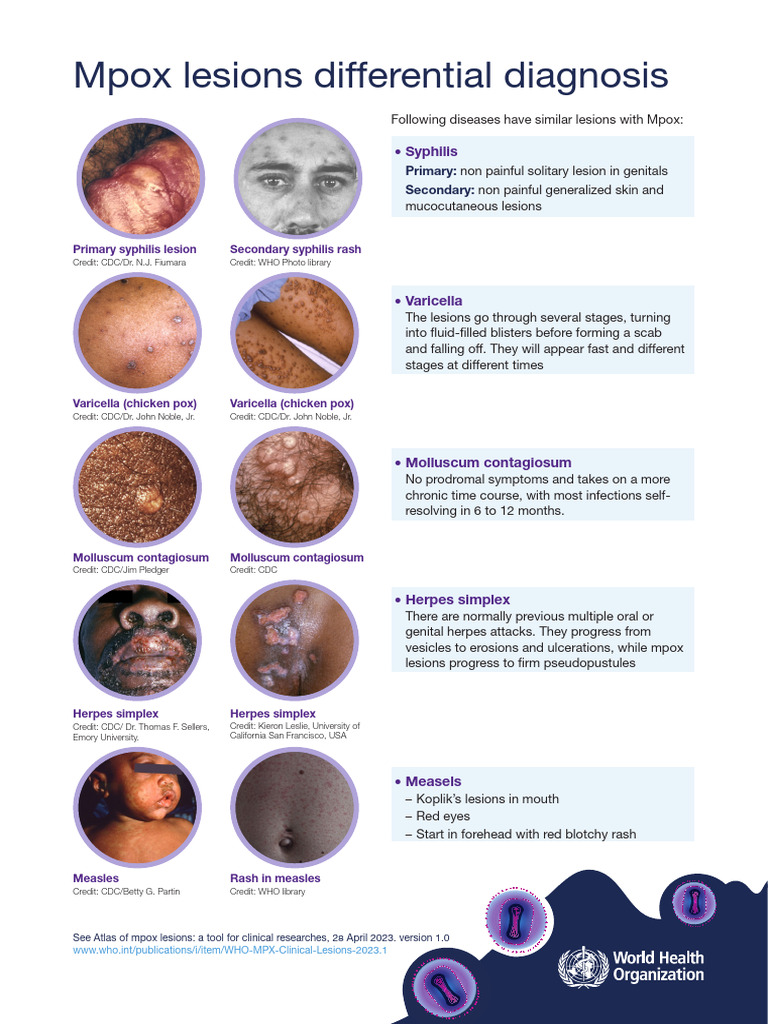 Mpox Lesions Differential Diagnosis - 13.11.2024 - Web | PDF | Medical ...