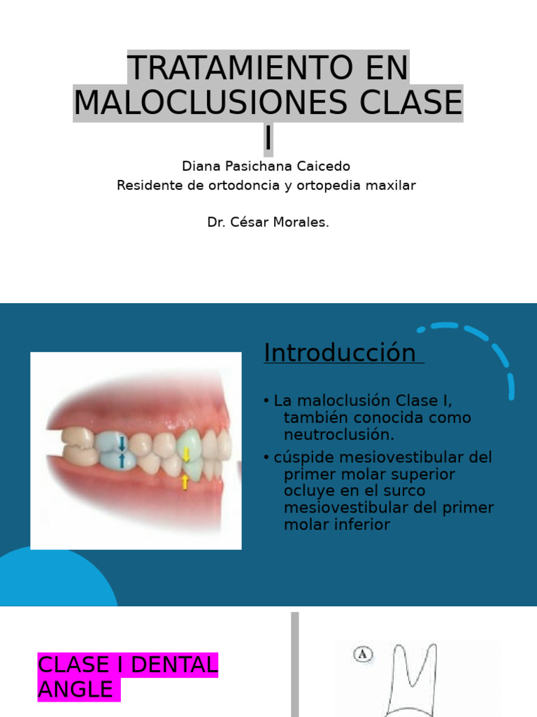 Tratamiento de Maloclusión Clase I | PDF | Ortodoncia | Boca
