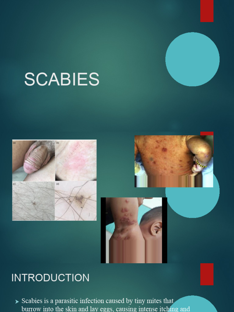 Scabies | PDF | Diseases And Disorders | Medical Specialties